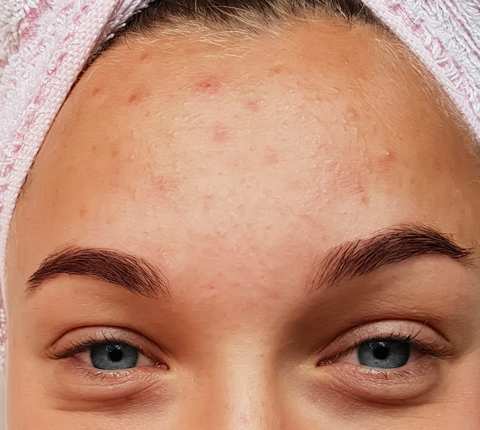 7 Causes of Adult Acne in Women + How to Prevent Breakouts – Bellavana ...